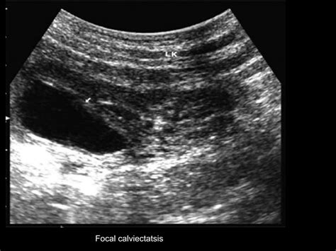 Imaging Features In Renal Tuberculosis Pptx