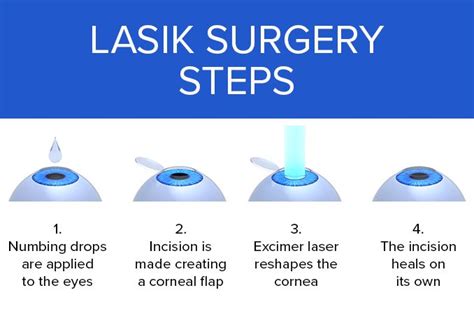 Lasik Surgery Definition Procedure Results