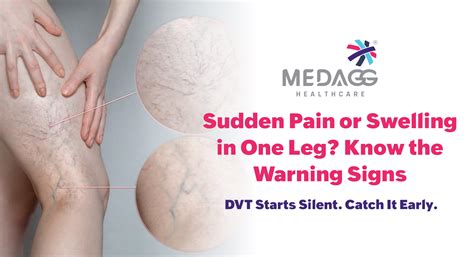 Early Stage Dvt Symptoms Leg What To Watch For And When To Act Medagg