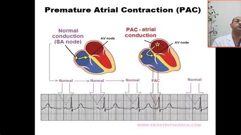 How To Differentiate Between Premature Atrial Pac And Ventricular Pvc Contraction P Ors