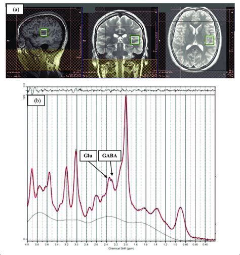 A Example Of 1 H MRS Voxel Placement In The Left Superior Temporal