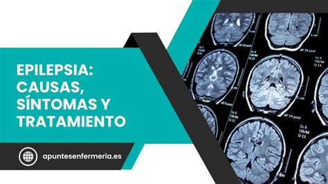 Epilepsia causas síntomas y tratamiento Apuntes enfermería