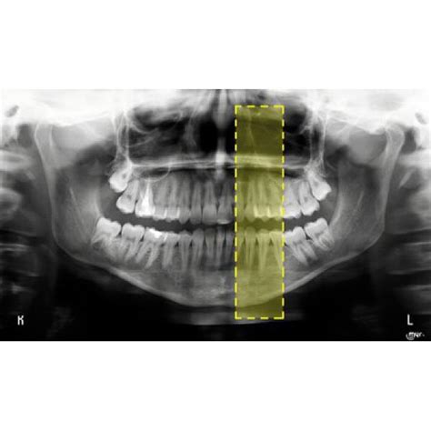 Vender Equipo De Rayos X Dental Eighteeth Hyperlight 2017 Rusia