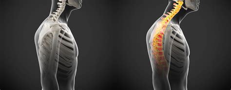 Understanding Postural Dysfunction Causes Effects And Physical Therapy Solutions Bear Lake