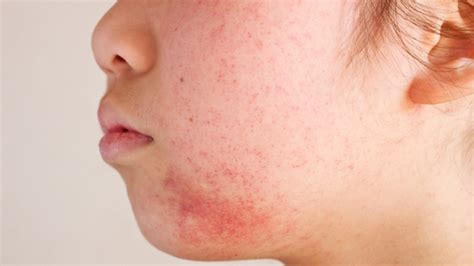 Dermatite Atopica Nei Bambini I Rimedi SapereSalute
