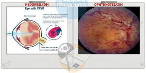 Guidelines For Management Of CRVO Meduweb