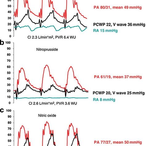 Increased Left Ventricular Diastolic Stiffness In Hfpef Demonstrated By