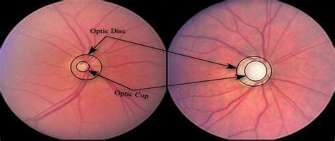 Optic Disc And Optic Cup In Retinal Fundus Image The Left Image Is A