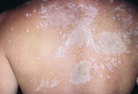 Lichen Sclerosus Et Atrophicus Back