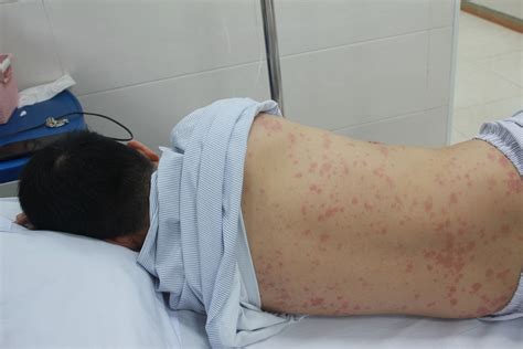 Người đàn ông Tử Vong Sau ăn Tiết Canh Lợn Báo Pháp Luật Việt Nam điện Tử