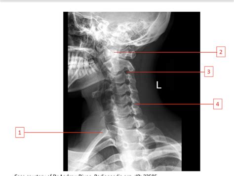 Diagram Of Oblique C Spine Quizlet