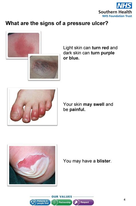 Common Sites Of Pressure Ulcers Vbctn