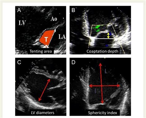 Key Echocardiographic Data In Secondary Mitral Regurgitation Concerning