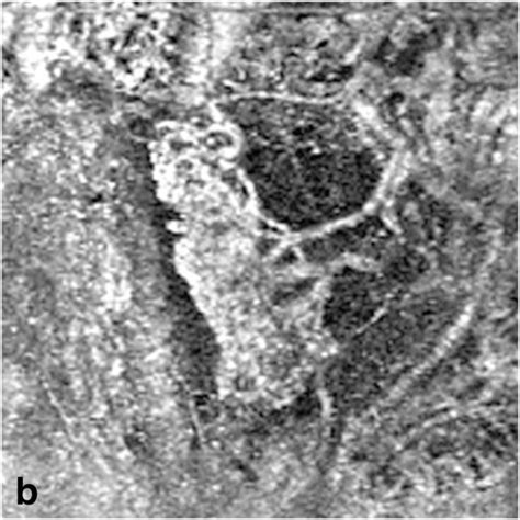 Different Patterns Of Myopic Choroidal Neovascularization Observed At