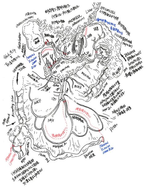 Illustration Of The Completion Gastrectomy Cholecystectomy And