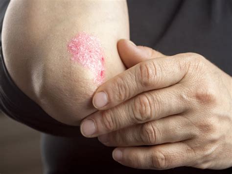 Sotyktu Deucravacitinib For Moderate To Severe Plaque Psoriasis Usa