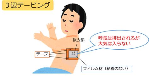 胸腔ドレナージ（チェストドレーンバック）の管理 ～ポイントを分かりやすく解説～ Icu看護師ダンカンの心外ブログ