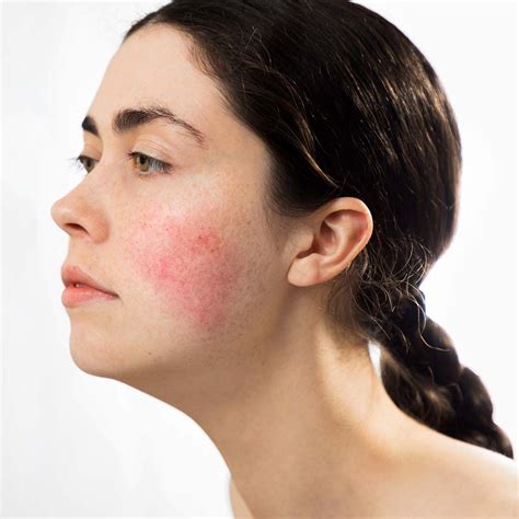 How To Reduce Skin Redness On Your Face Cetaphil Canada