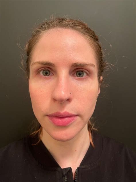 Daxxify Review Daxxify Before And After Photos