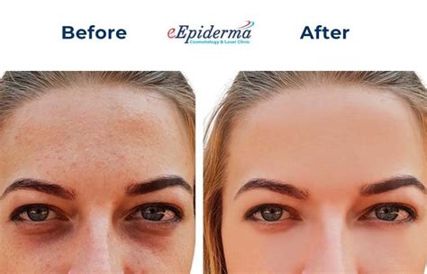 Best Dark Circles Removal Treatment In Durgapur