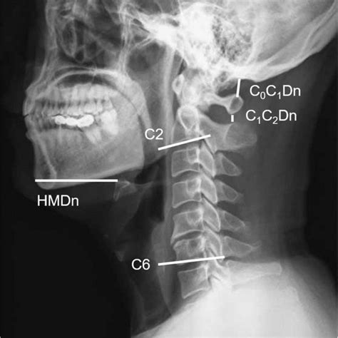 Lateral Cervical X Ray Film In The Neutral Positions Hmdn The