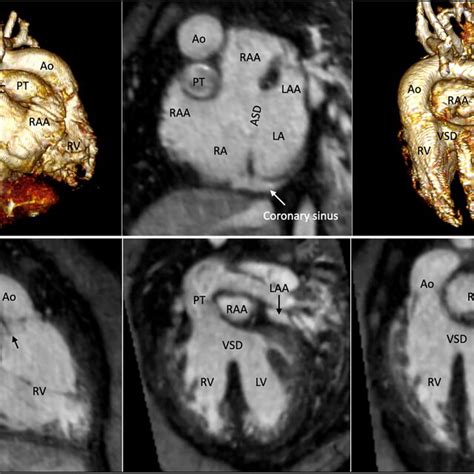 Case 5 Partial Left Juxtaposition Of The Atrial Appendages In A Download Scientific Diagram