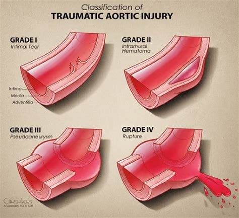Grading Classification Of Traumatic Aortic Injury Introduced By