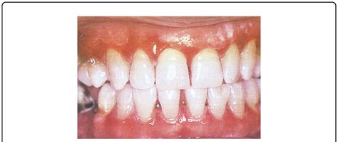 Clinical Condition With Redness Desquamation And Swelling Of The