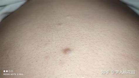 求助胸口长痘痘是什么 知乎