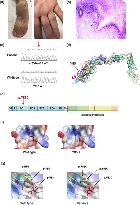 Striate Palmoplantar Keratoderma Resulting From A Missense Mutation In Dsg1 Abstract Europe Pmc