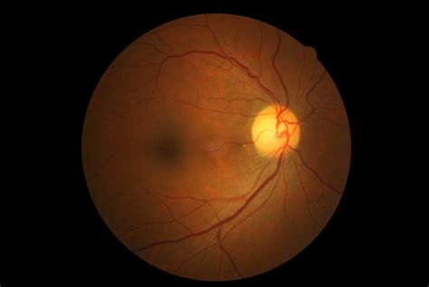 Disc Hemorrhage With Low Intra Ocular Pressure An Evidence Based Approach Published In Cro