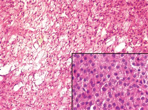 Ossifying Fibromyxoid Tumor — Diagnostic Challenge For A