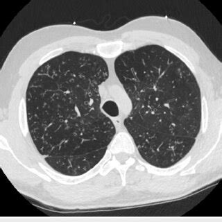 CT Scan Of The Chest Showing Air Trapping And Tree In Bud Opacities Download Scientific Diagram
