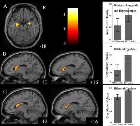 Sex Differences Of Gray Matter Morphology In Cortico Limbic Striatal