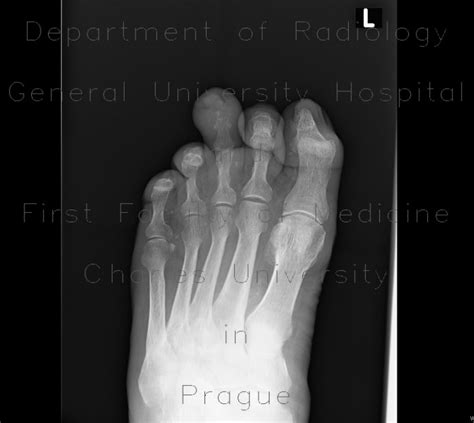 Radiology Case Osteomyelitis Of Toe