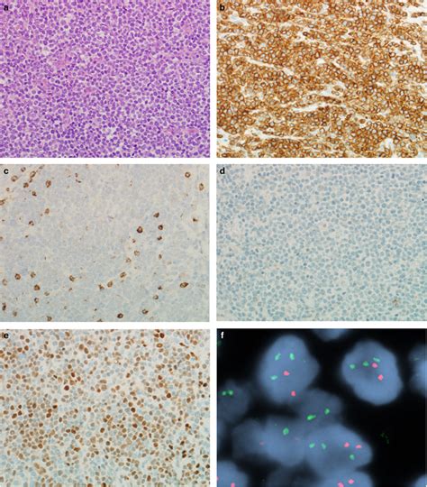 Peripheral T Cell Lymphoma Not Otherwise Specified A Sheets Of