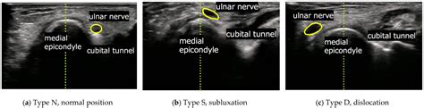 Ulnar Nerve Subluxation Clinical Anatomy Kenhub