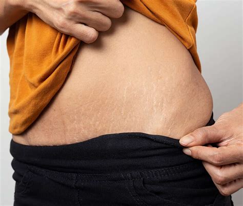 Treatment For Stretch Marks Reading Milan Skin Clinic
