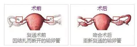 输卵管复通手术，你了解多少？进行情况检查