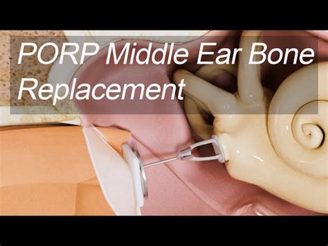 Incus Prosthesis A Rare Cause Of Stapedotomy Failure When The Depth
