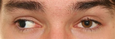 View Of Approach To Strabismus Mcgill Journal Of Medicine