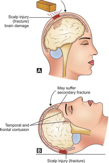 Skull Indentation In Adults Pregnancy Informations