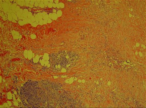Mesenteric Biopsy Low Power View Showing Fat Necrosis Chronic
