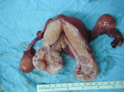 Nabothian Cyst Semantic Scholar