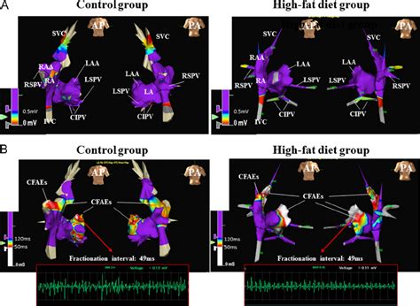 Representative 3d Voltage A And Complex Fractionated Atrial
