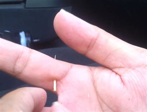 11 Hacks On How To Remove A Splinter Without Using Tweezers