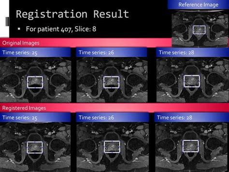 Post Processing Of Prostate Perfusion Mri Pptx Medical Tests Medical Health