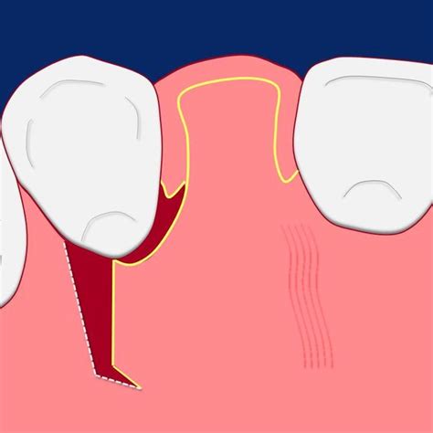 Schematic Representation Closure Note Minimally Exposed Tissue