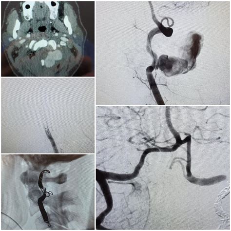 Ian Kaminsky On Linkedin Rianeurovascular Penumbrapod