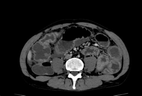 Radiopaedia Case Behçets Disease Abdominal Vasculitis Id 55955 Study